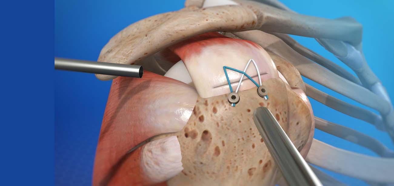 Arthroscopic Rotator Cuff Repair Dr Atul Patil Arthroscopic Rotator Cuff Repair Dr Atul Patil
